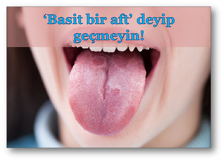 Dil kanserinin 5 önemli belirtisi - SAĞLIK - TUKETİCİ HABER AJANSI